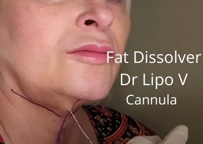 Fat Dissolver - Dr Lipo V | Cannula| Double Chin - DIY55