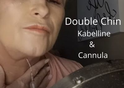 Get rid of Double Chin | Kabelline - Fat Dissolver - DIY55