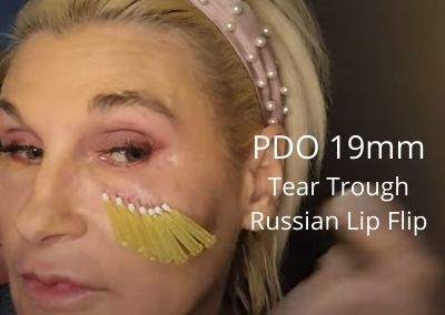 Tear Troughs and Russian Lip Flip - PDO Threads 30g 19mm - DIY55