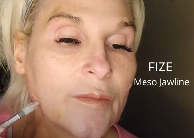 Jawline - Meso with FIZE - DIY55